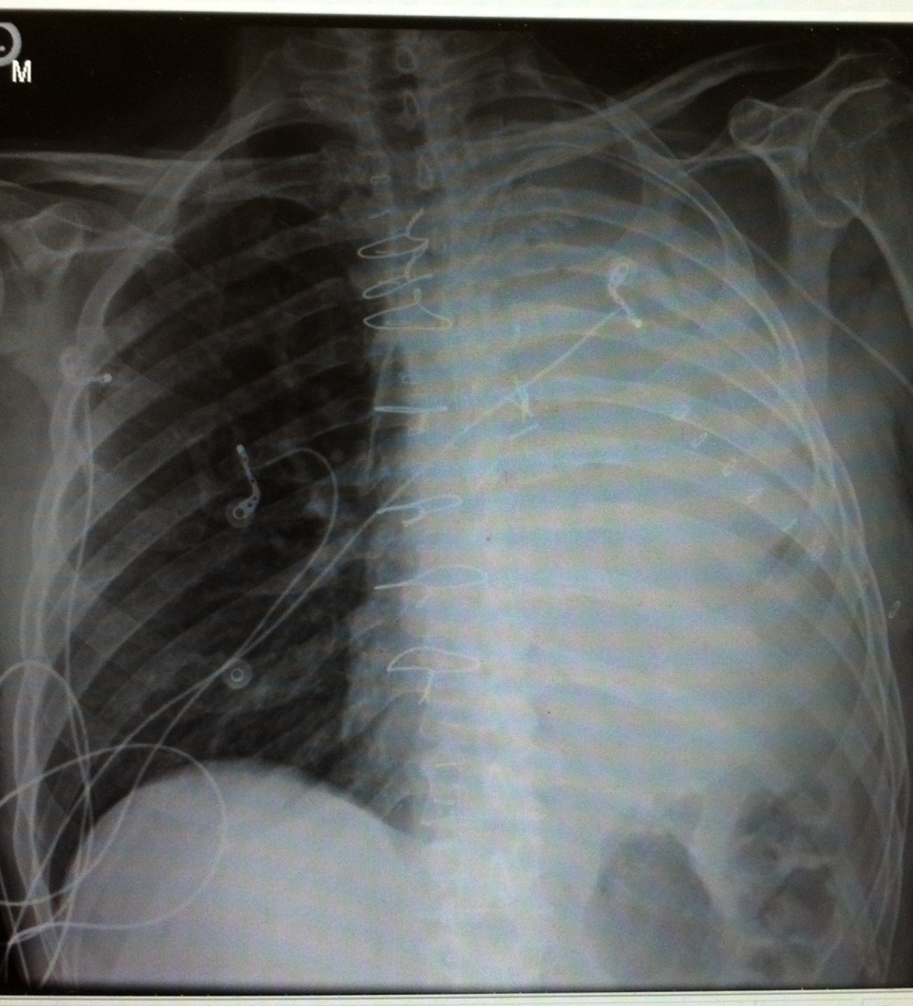 case-presentation-cardiac-complications-after-lung-surgery-sts